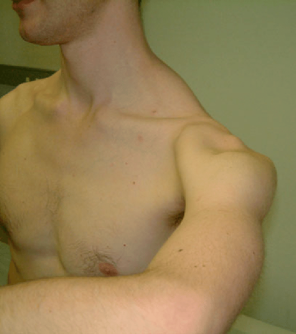 Shoulder Instability Surgery - Jason Hockings